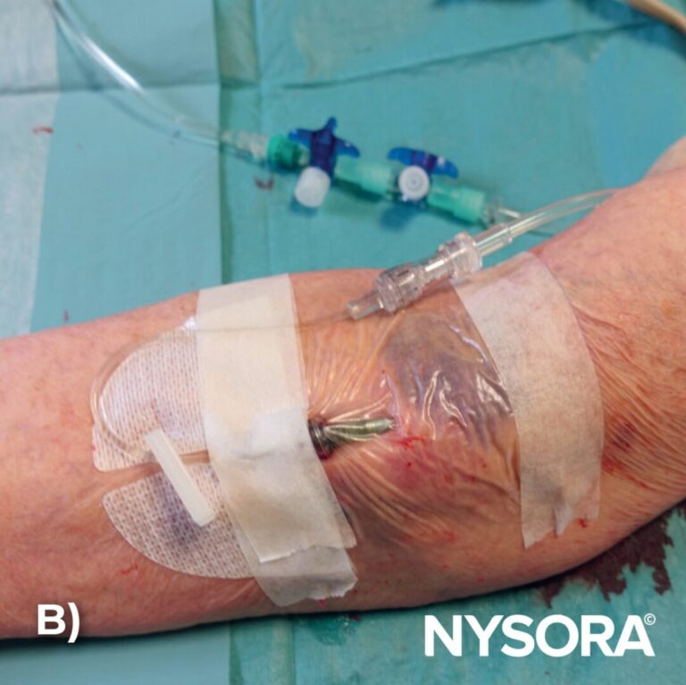 IV access in elderly patients - NYSORA