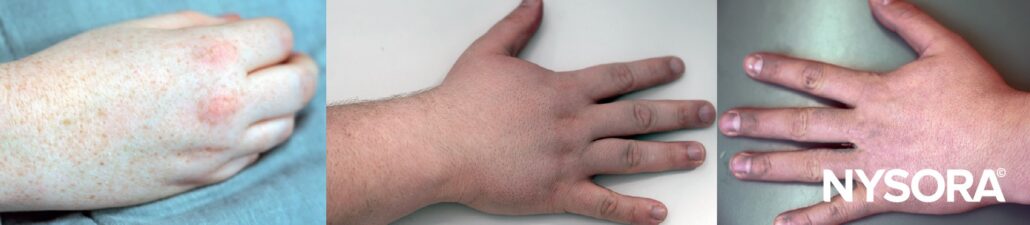 IV access in obese patients - NYSORA