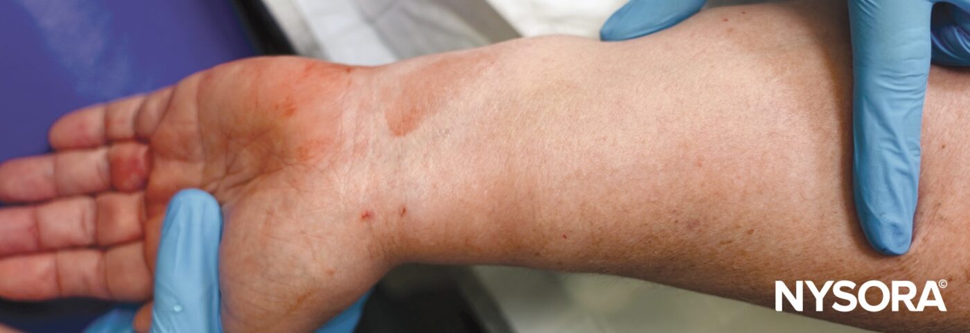 IV access in obese patients - NYSORA