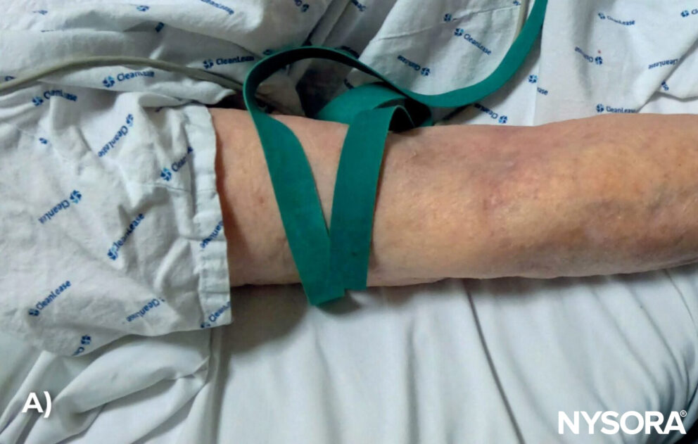 IV access in patients with diabetes - NYSORA