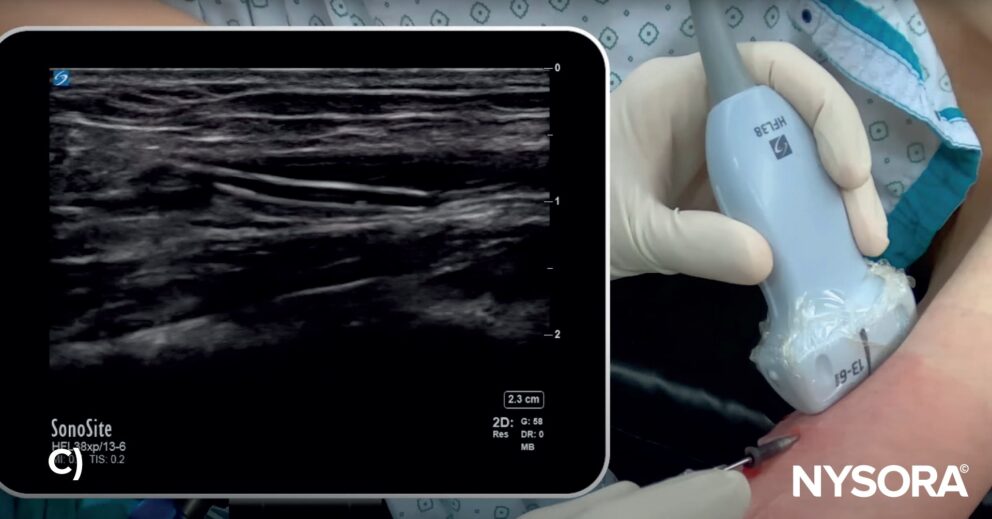 Transducer-needle orientation for US-guided IV access - NYSORA