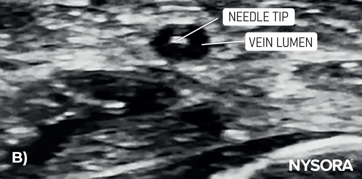 Transducer-needle orientation for US-guided IV access - NYSORA