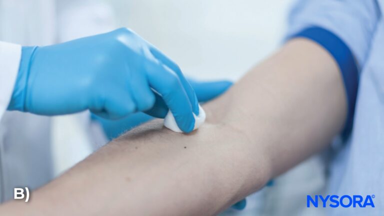 Ultrasound-guided IV access technique - NYSORA