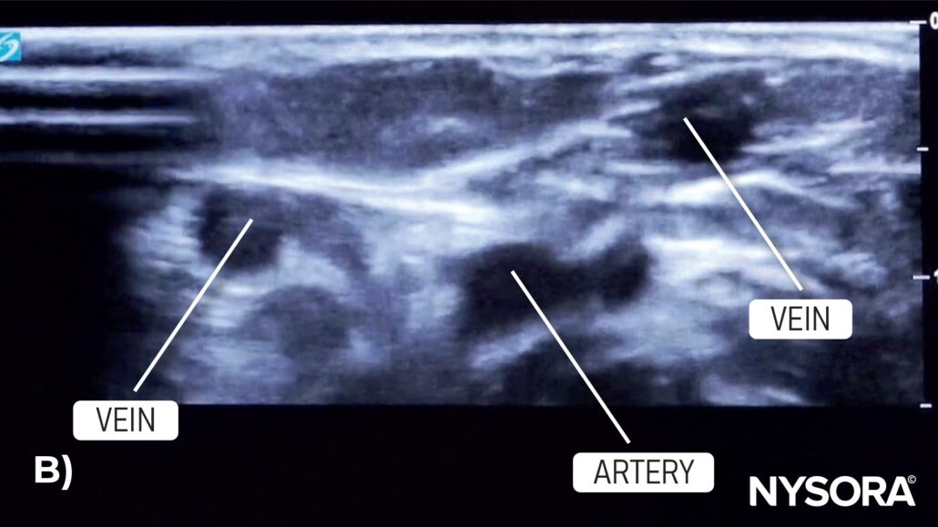 Ultrasound-guided IV access technique - NYSORA
