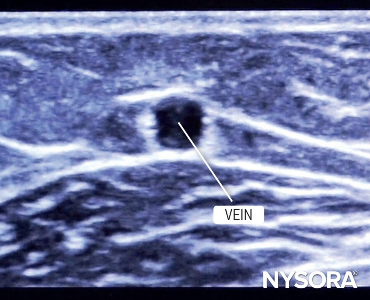 Ultrasound-guided IV access technique - NYSORA