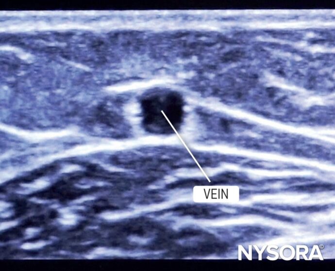 Ultrasound-guided IV access technique - NYSORA