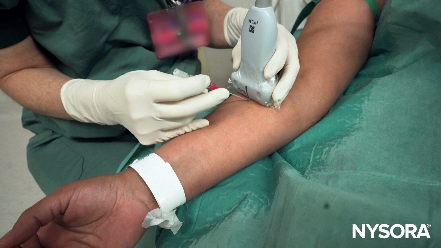 Ultrasound-guided IV access technique - NYSORA