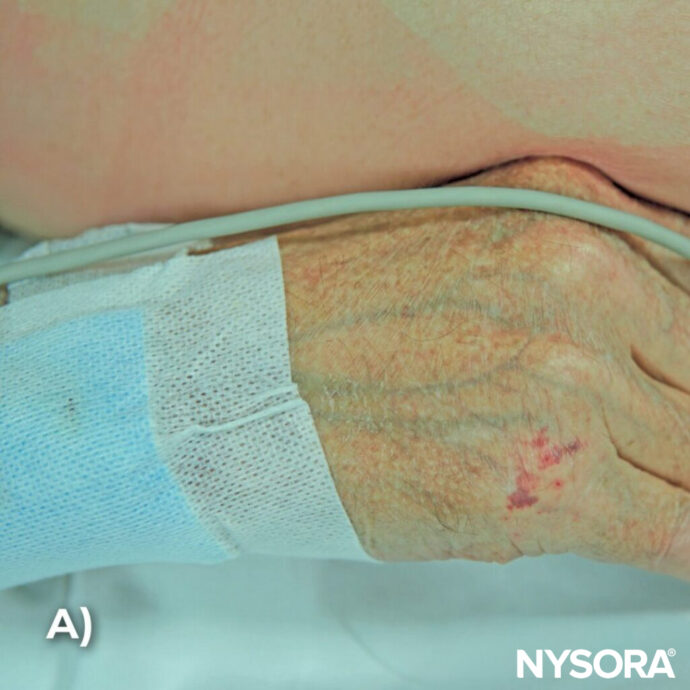 IV access in elderly patients - NYSORA