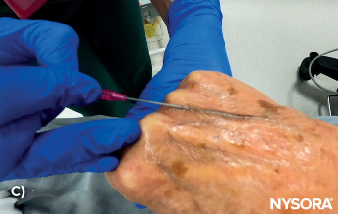 IV access in elderly patients - NYSORA