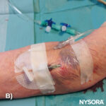 IV access in elderly patients - NYSORA