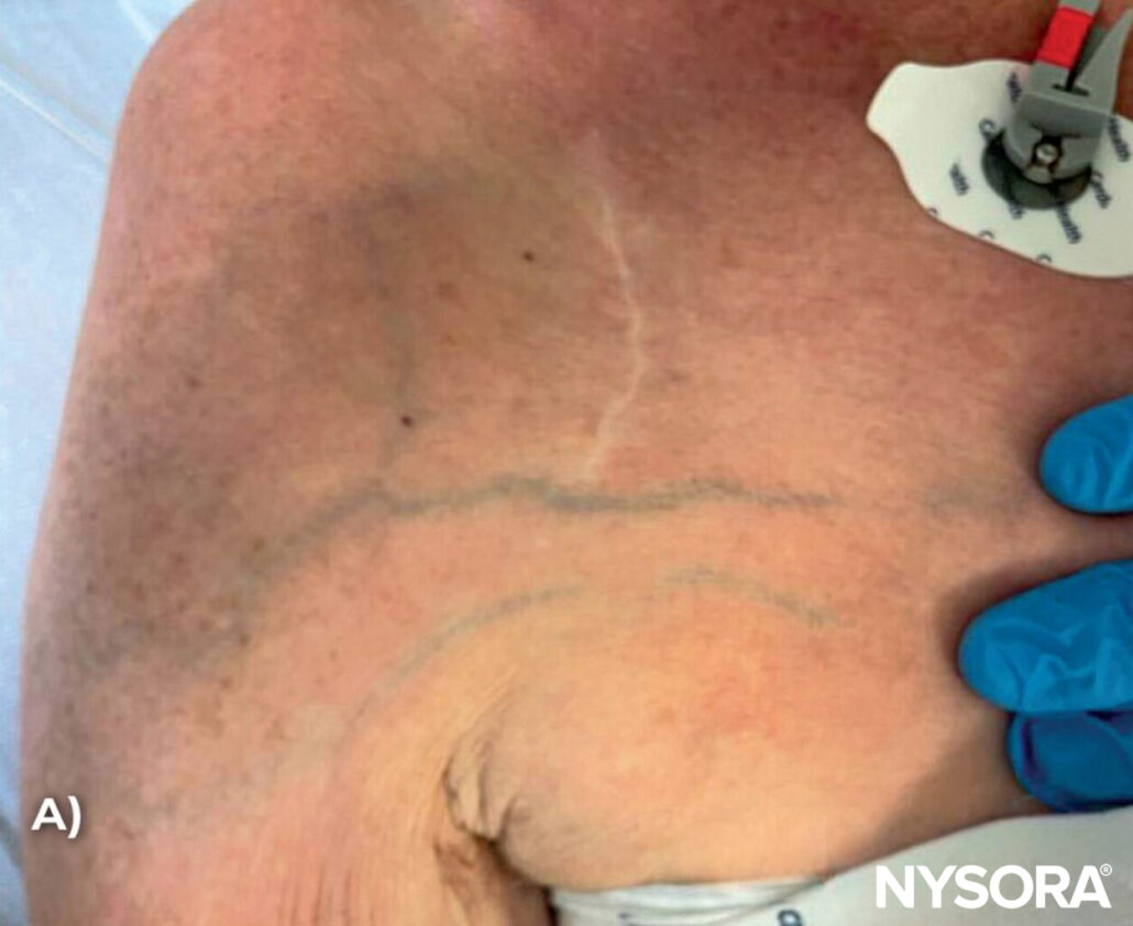 IV access in obese patients - NYSORA
