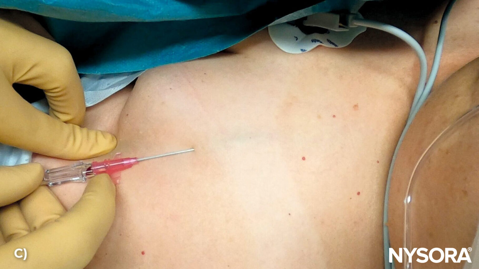 IV access in obese patients - NYSORA