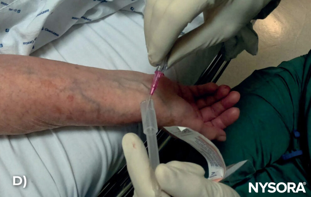 IV access in patients with diabetes - NYSORA