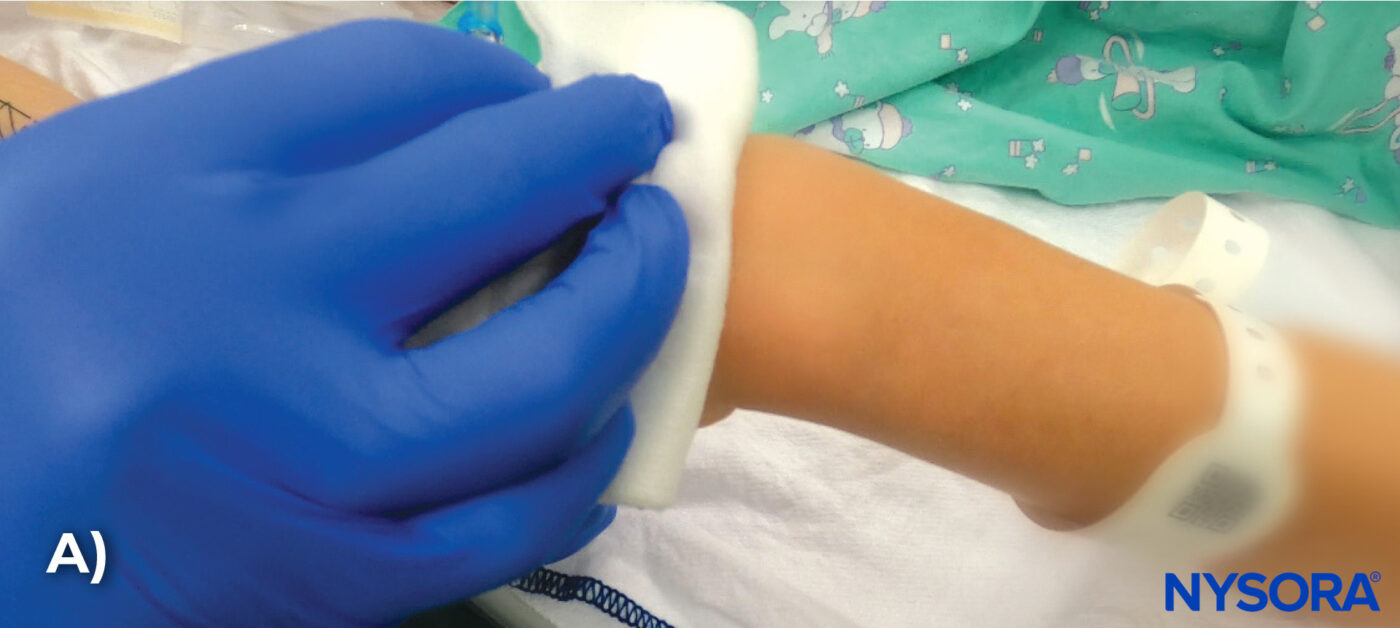 IV access in pediatric patients - NYSORA
