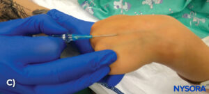 IV access in pediatric patients - NYSORA
