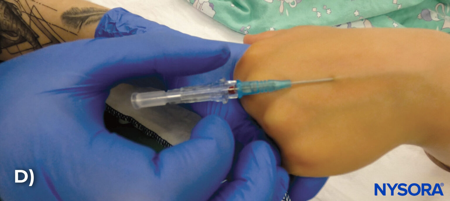 IV access in pediatric patients - NYSORA