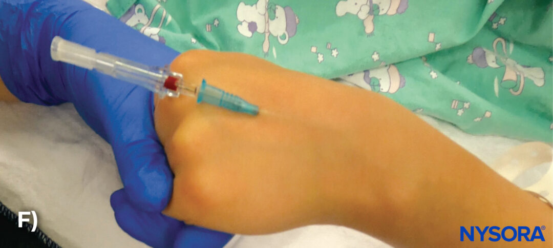 IV access in pediatric patients - NYSORA