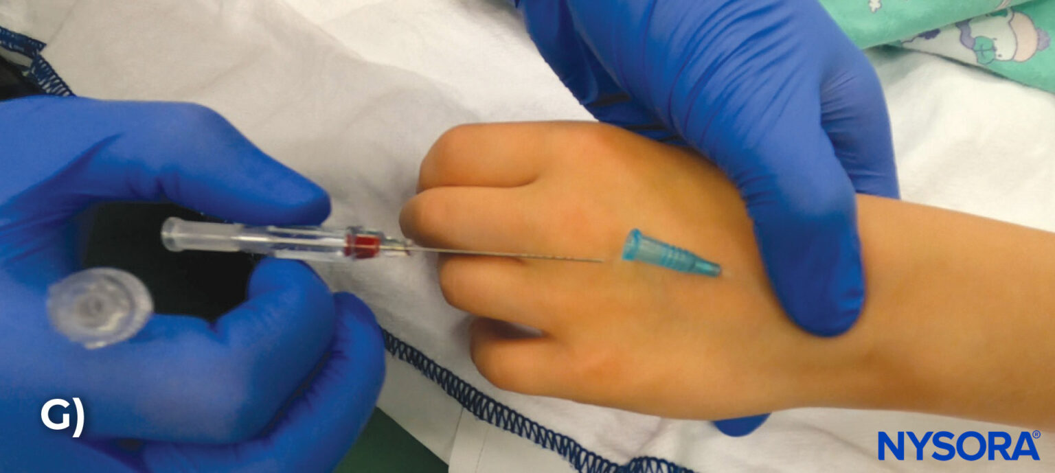 IV access in pediatric patients - NYSORA