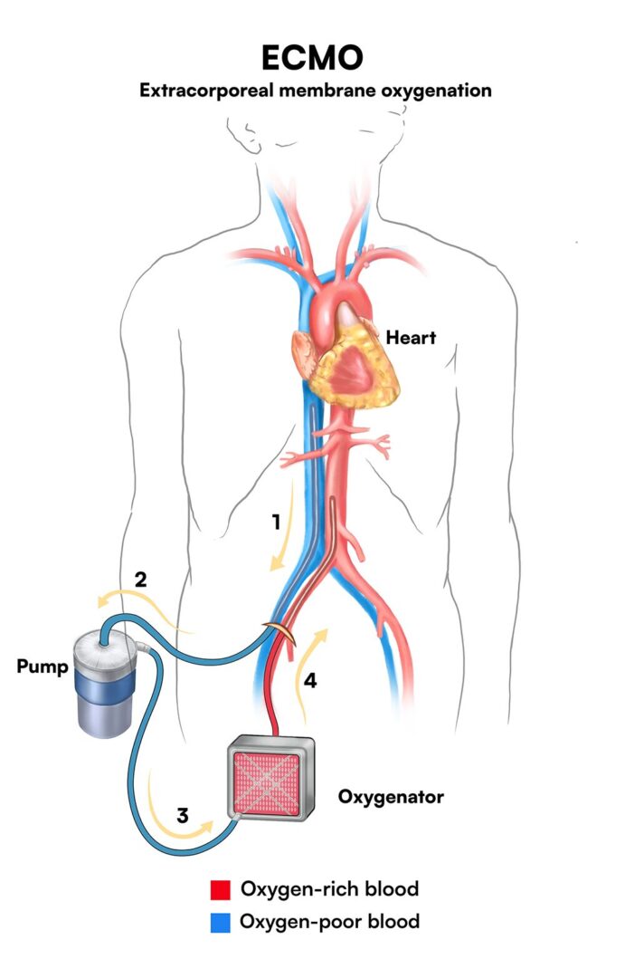 Hyperoxia in ECMO: A Hidden Threat? - NYSORA