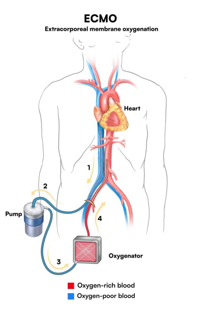 Can ECPR redefine outcomes in perioperative cardiac arrest? - NYSORA