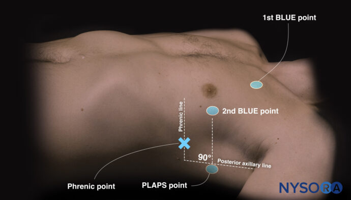 Essential lung ultrasound - NYSORA