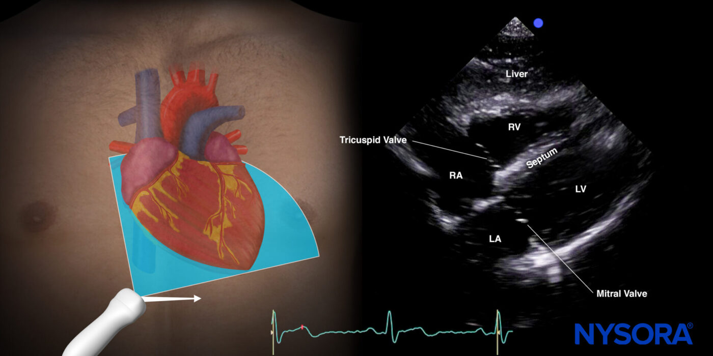 Central venous catheter position - Rapid atrial swirl sign (RASS) - NYSORA